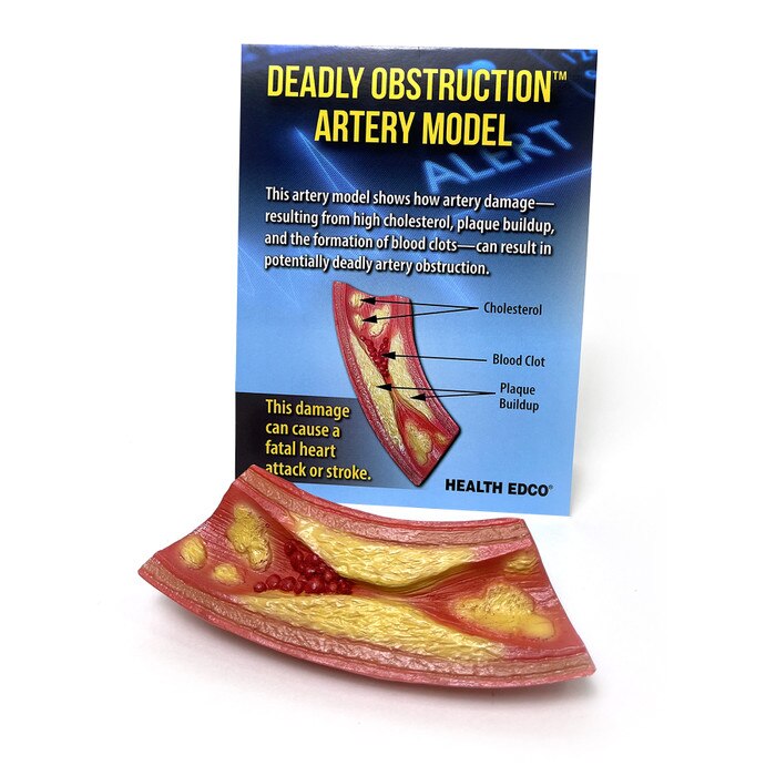 Deadly Obstruction Artery Model | Health Edco