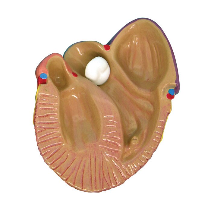 Heart Disease Model Set | Health Edco | Anatomical Models
