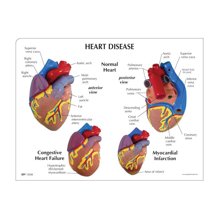 Heart Disease Model Set | Health Edco | Anatomical Models