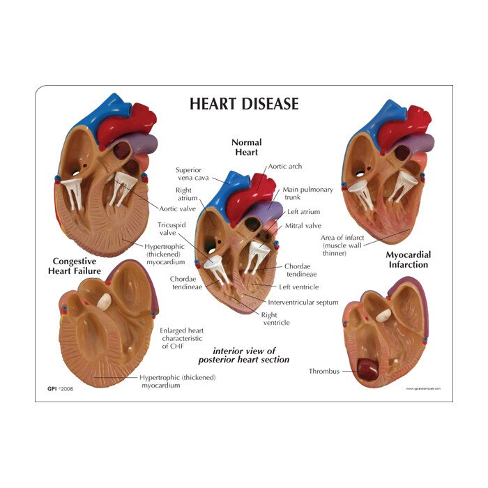 Heart Disease Model Set | Health Edco | Anatomical Models