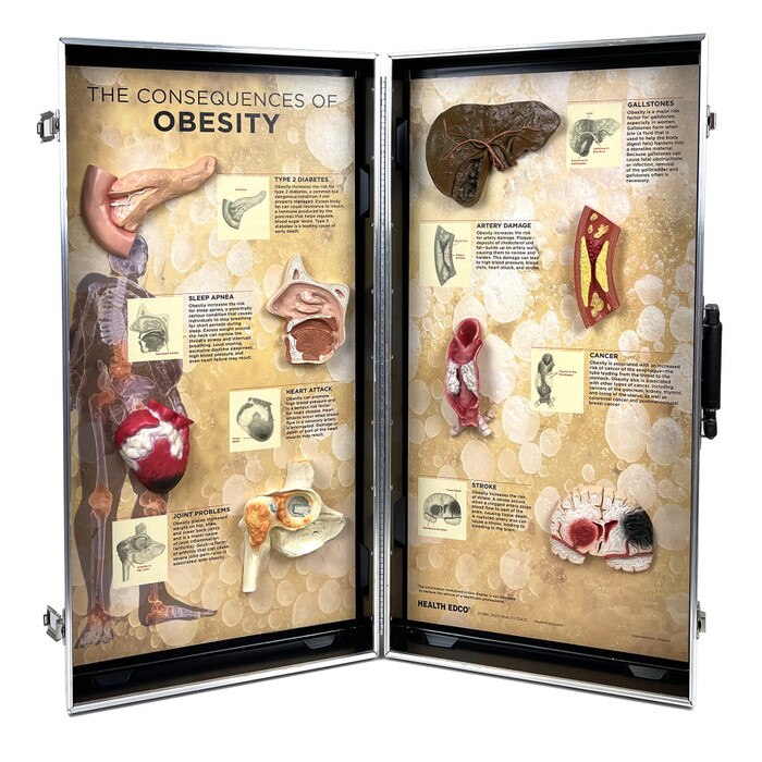 Obesity Health Consequences 3-D Display | Health Edco